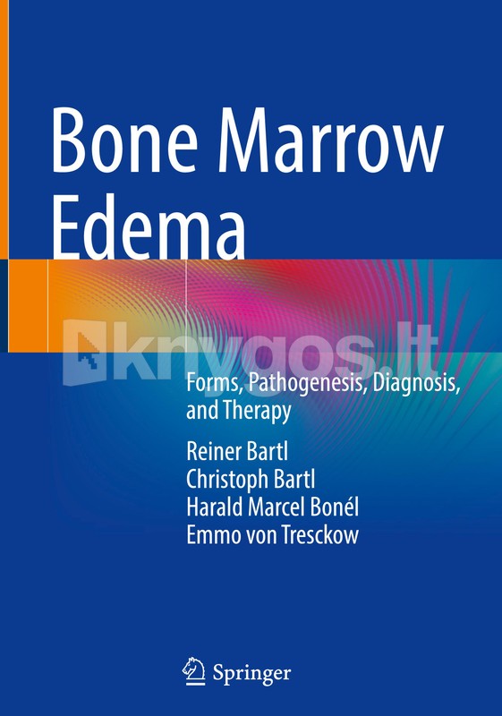 Bone Marrow Edema + NEMOKAMAS ATVEŽIMAS! | Knygos.lt
